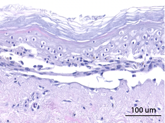 InflammaSkin®: a unique human psoriasis model for inflammation studies