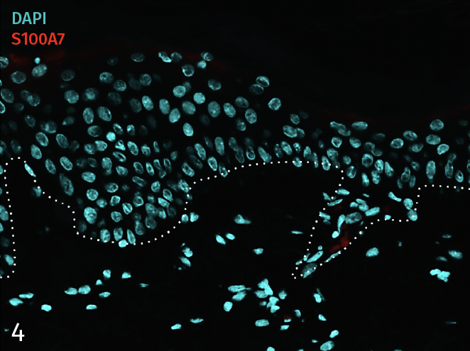 InflammaSkin®: a unique human psoriasis model for inflammation studies