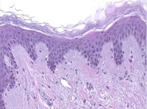 InflammaSkin®: a unique human psoriasis model for inflammation studies